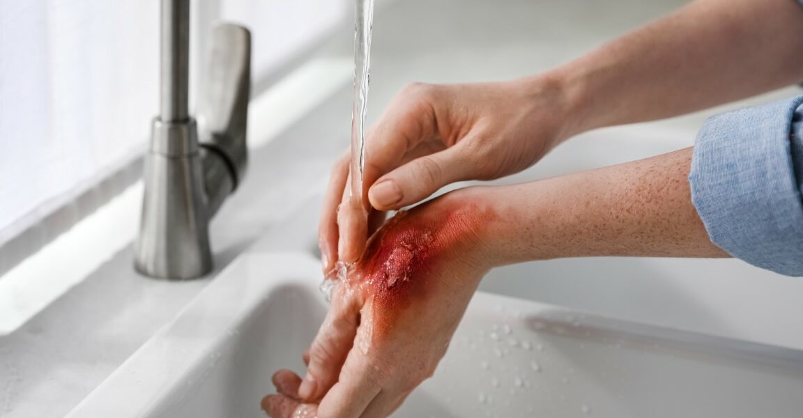 Burn Care Do's and Don'ts : Treatment and Pain Management